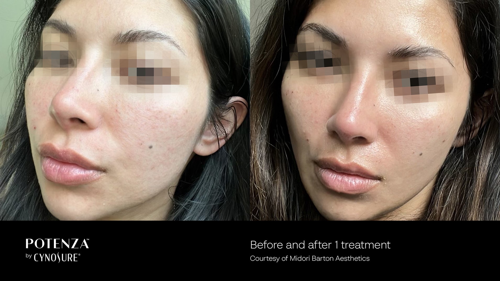 Discover the Magic of Potenza RF Microneedling at Skin Mix in Denver's ...